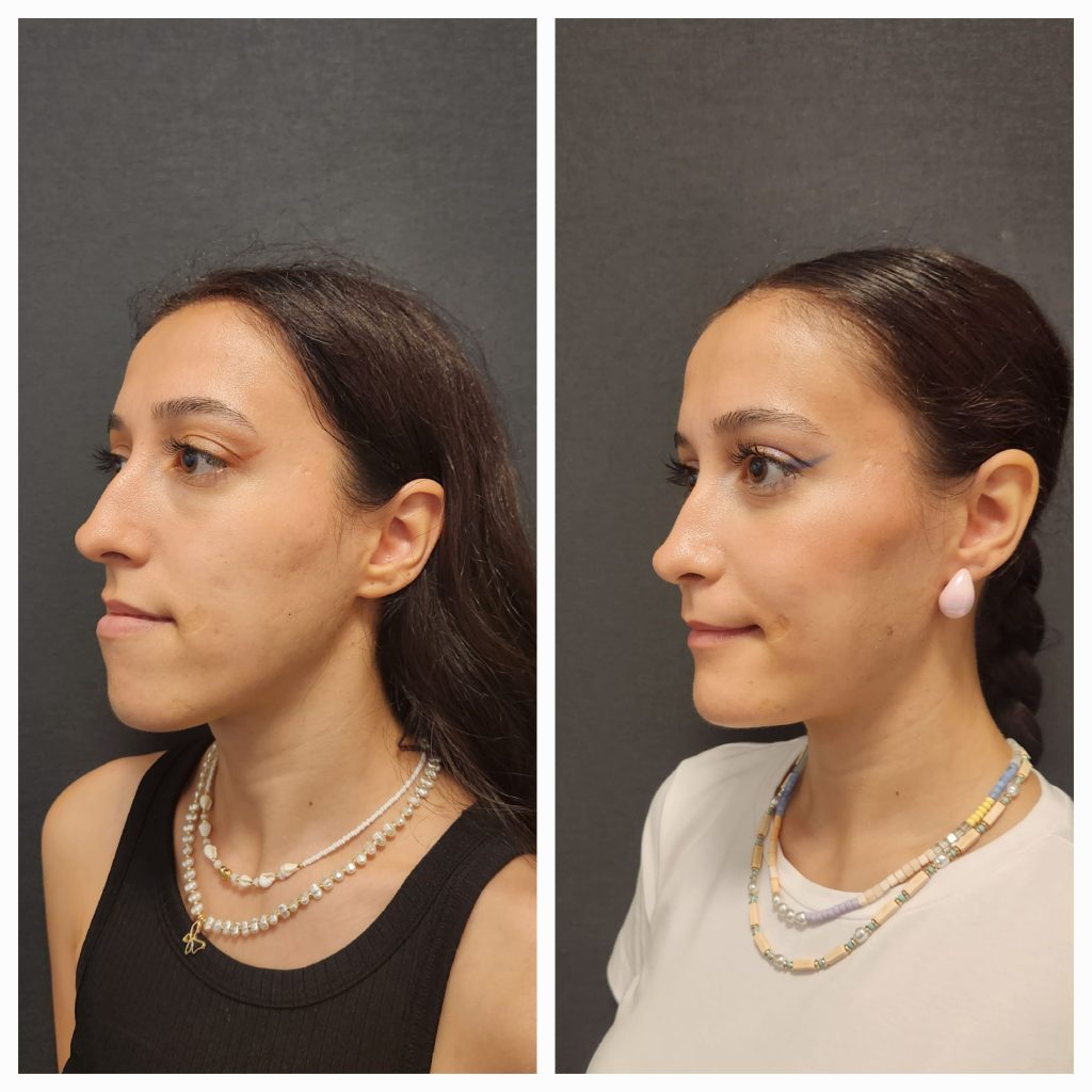 TMJ Surgery Before and After Photos