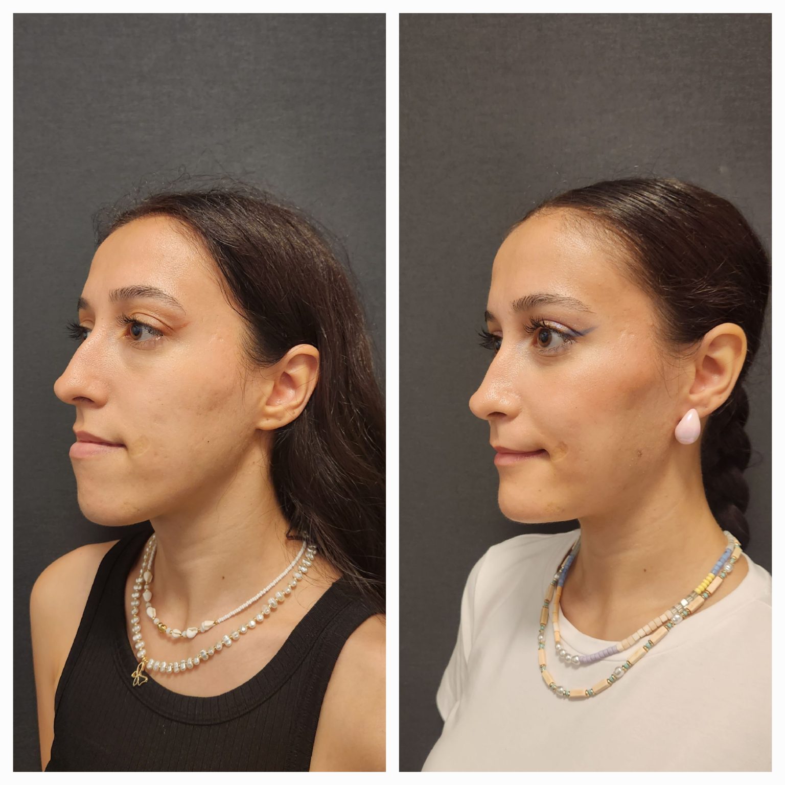 TMJ Surgery Before and After Photos