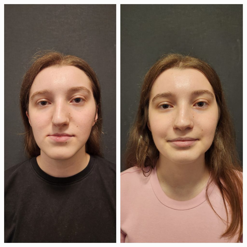 TMJ Surgery Before and After Photos