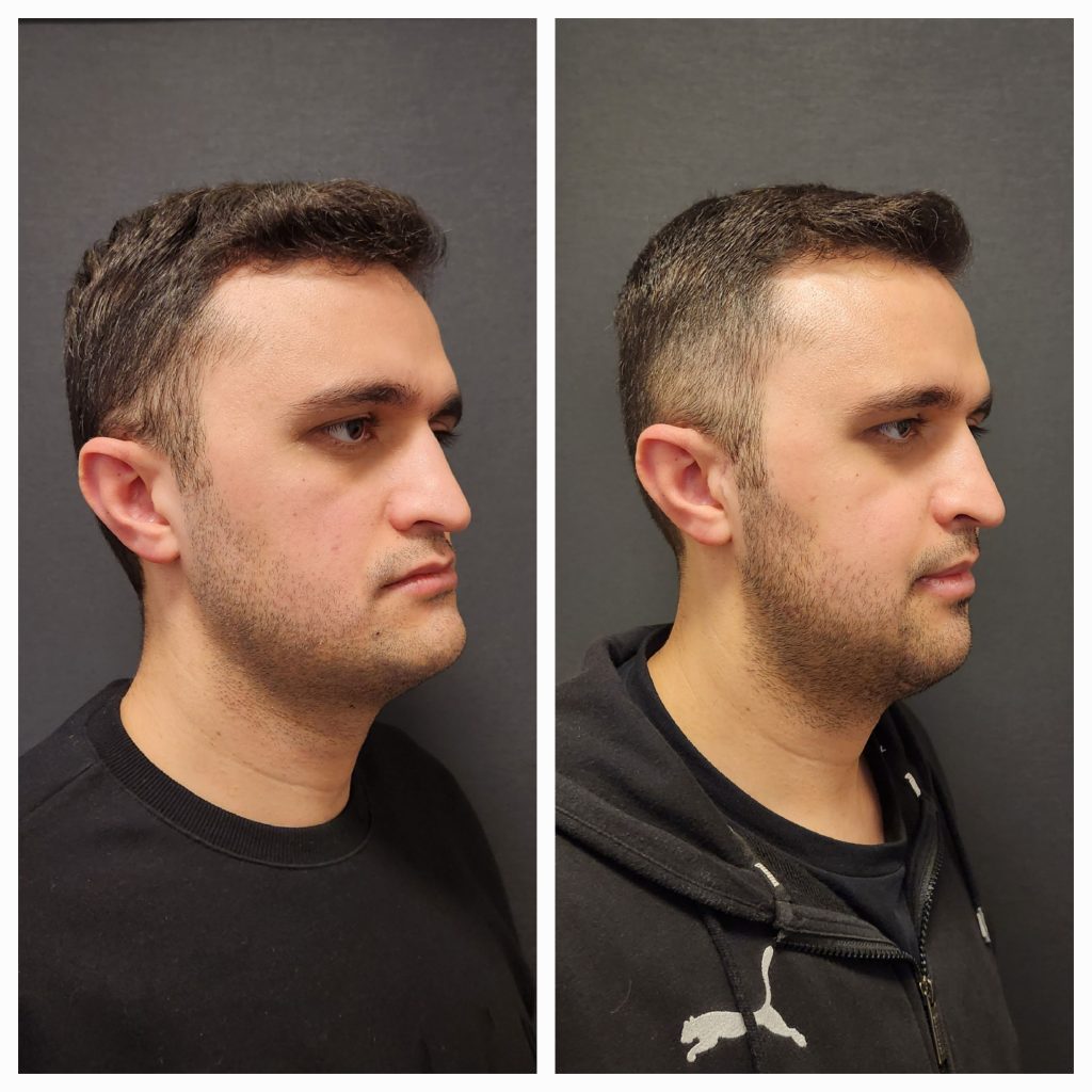 TMJ Surgery Before and After Photos