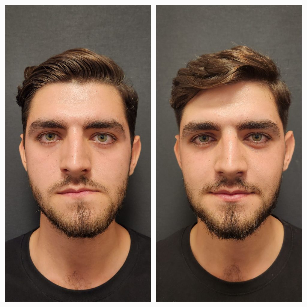 TMJ Surgery Before and After Photos