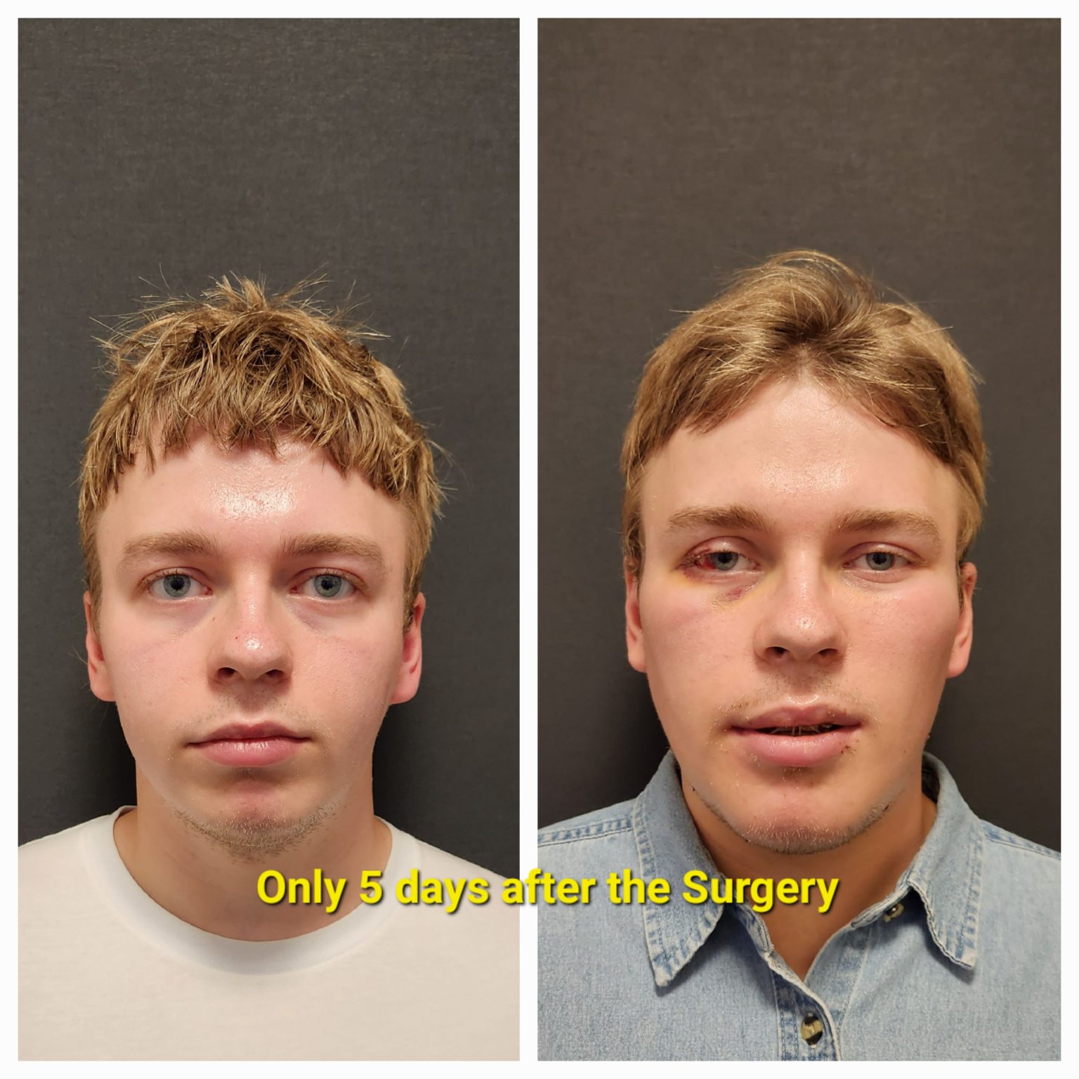 TMJ Surgery Before and After Photos