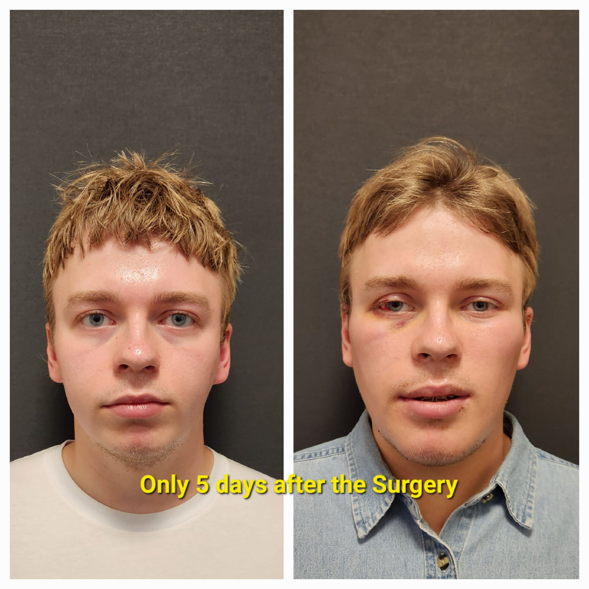 TMJ Surgery Before and After Photos