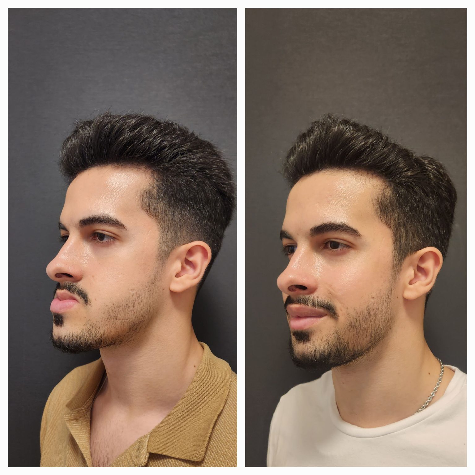 TMJ Surgery Before and After Photos